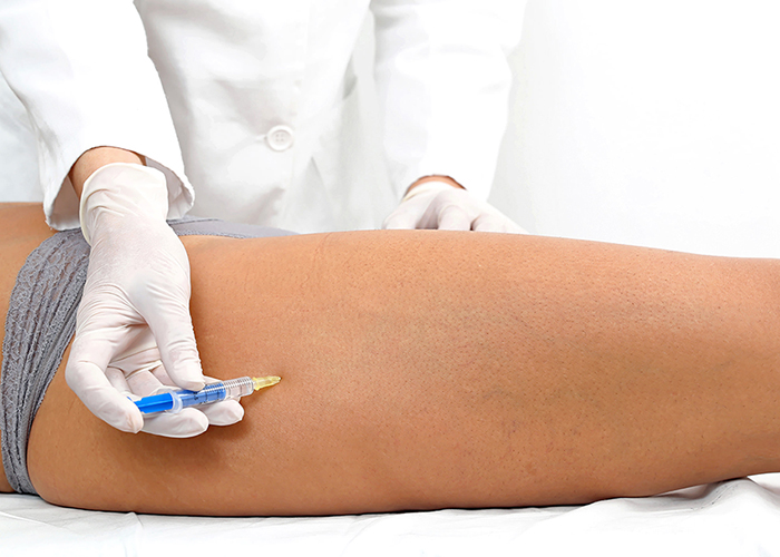 Le traitement des varices par injections - sclérothérapie - risqué?